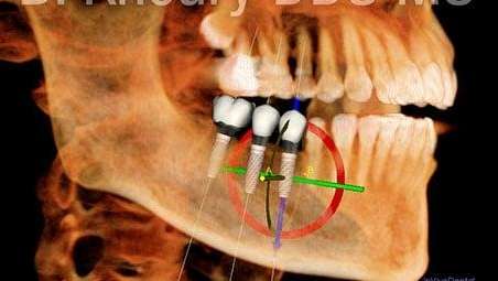 CBCT: What is it? | Dental Implants Nampa ID